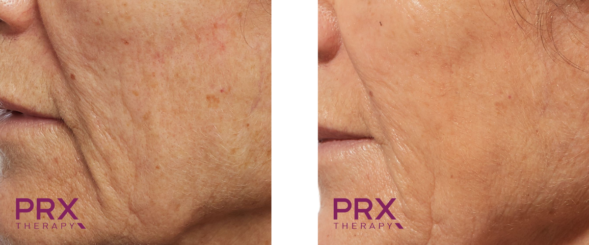 PRX-T33 Skin Booster – No Needle – Huidtherapie Meijer