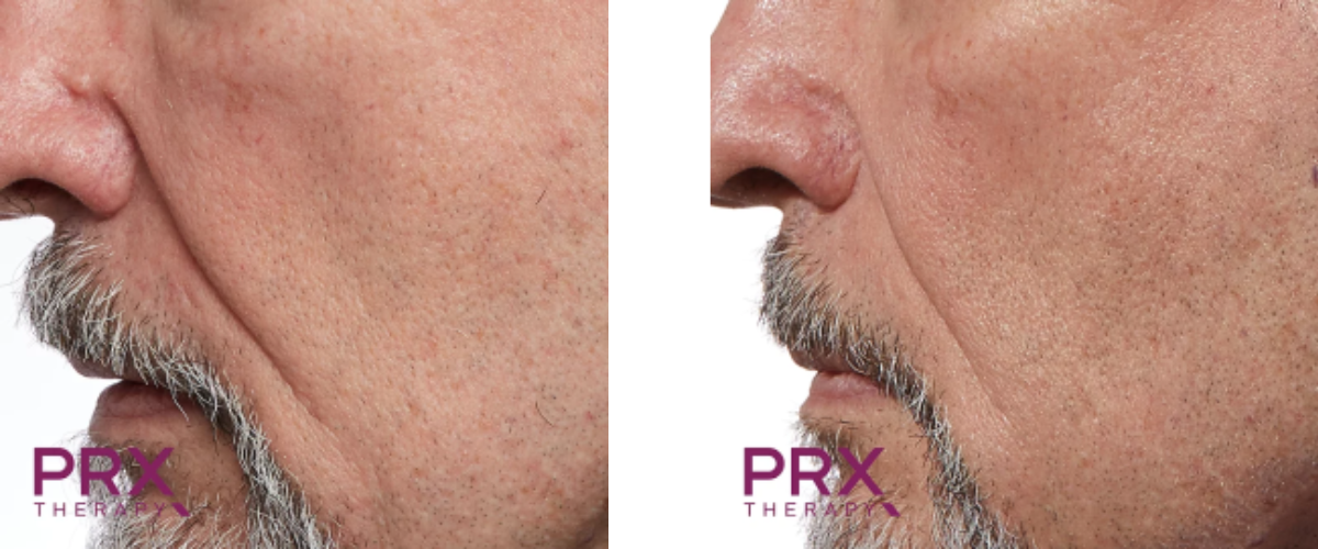 PRX-T33 Skin Booster – No Needle – Huidtherapie Meijer